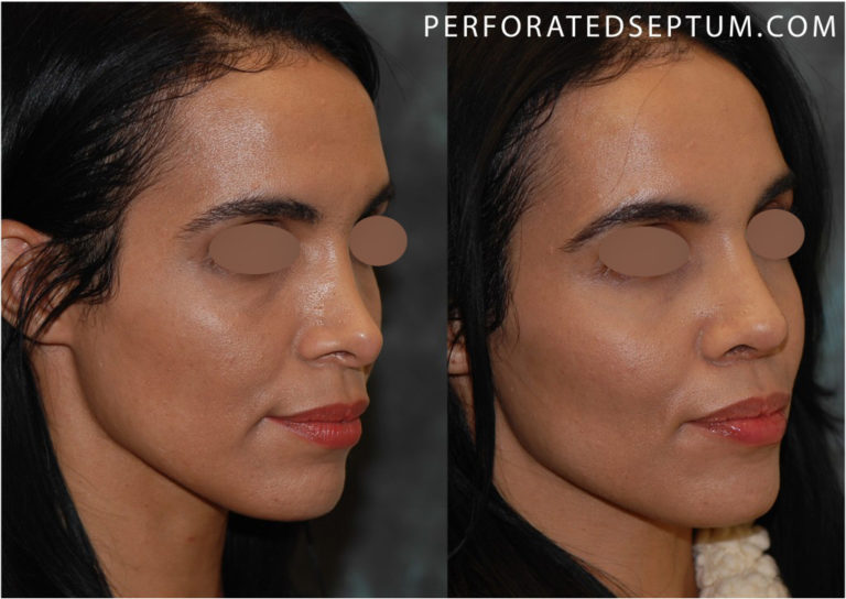 Septal Perforation Repair Specialist Dr. Jason Hamilton Los Angeles