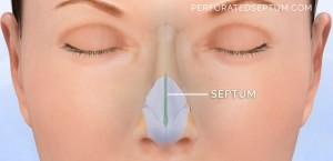Perforated Septum, Dr. Hamilton - Surgical Repair of a Hole in the Septum