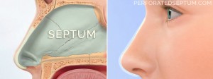 Perforated Septum, Dr. Hamilton - Surgical Repair of a Hole in the Septum