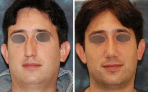 Nasal Fractures, Septal Hematoma, and Septal Perforation - Perforated ...