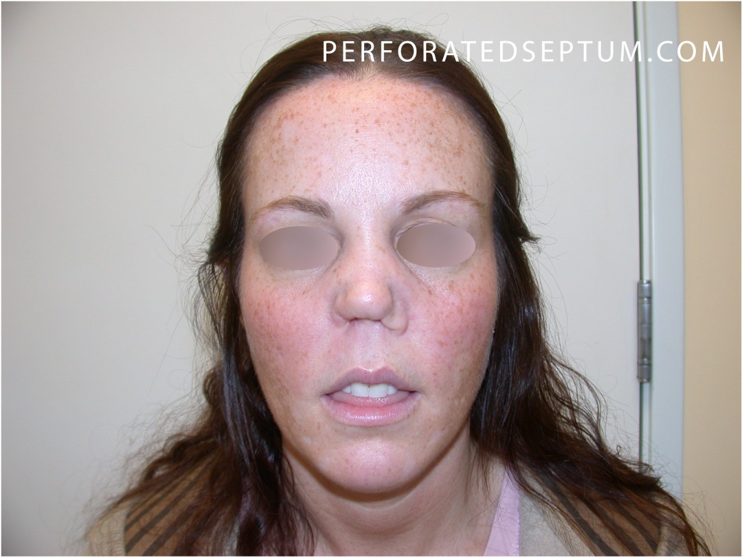 Perforated Septum, Dr. Hamilton - Surgical Repair of a Hole in the Septum