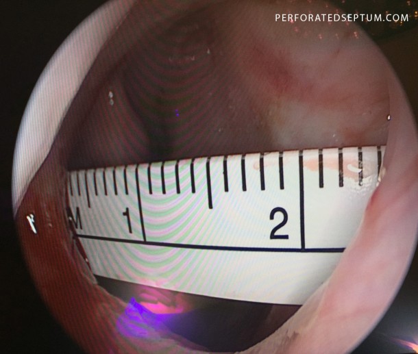 Perforated Septum, Dr. Hamilton - Surgical Repair of a Hole in the Septum